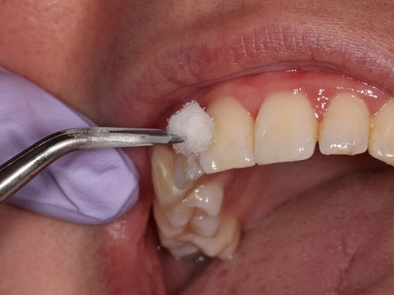 Testing pulp vitality for overall dental pulp health